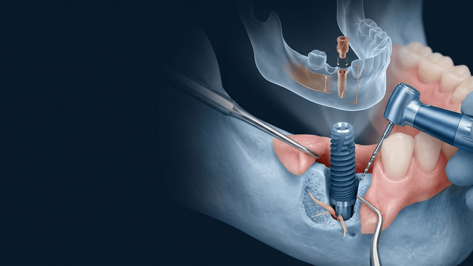 Immediate Implant Placement: 2025 Evidence-Based Guide | Periospot
