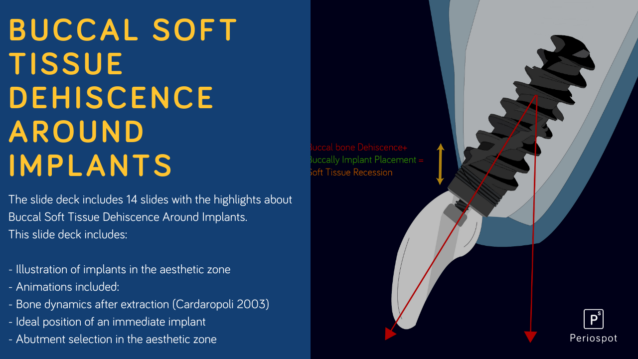 Implant Complications Slide Deck: Buccal Soft Tissue Dehisc | Periospot