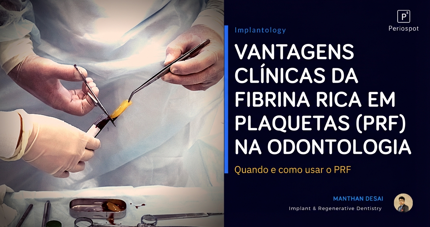 Vantagens Clínicas da Fibrina Rica em Plaquetas (PRF) na Odontologia ...